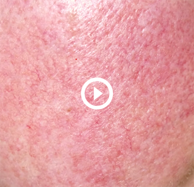 Beauty School Store | Blog | Skin Disorders: Rosacea ...